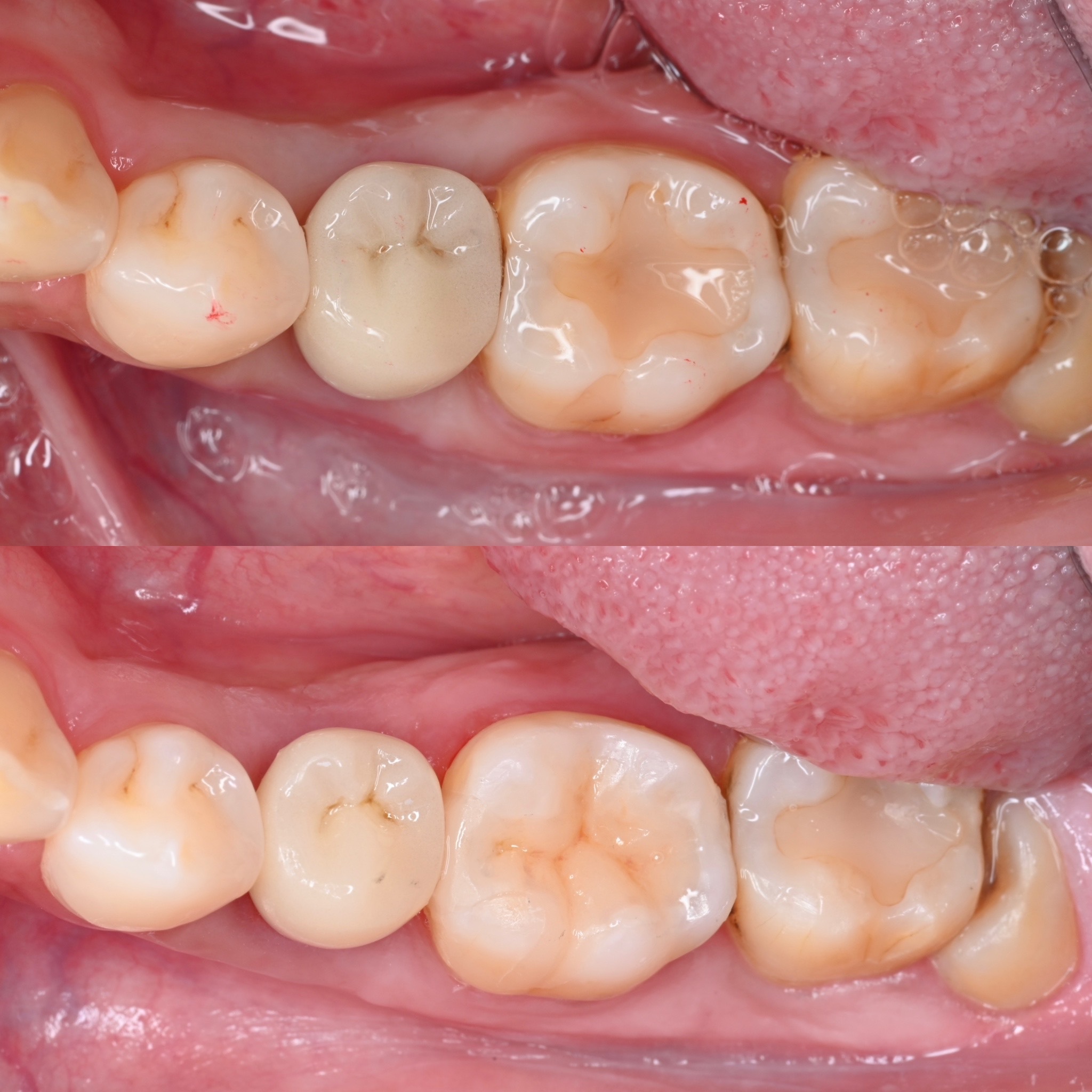 左下大臼歯のemax Inlayによる治療 | 北砂の歯医者【公式】砂町北歯科｜歯周病・根管治療・セラミック・インプラントに強い歯科医院